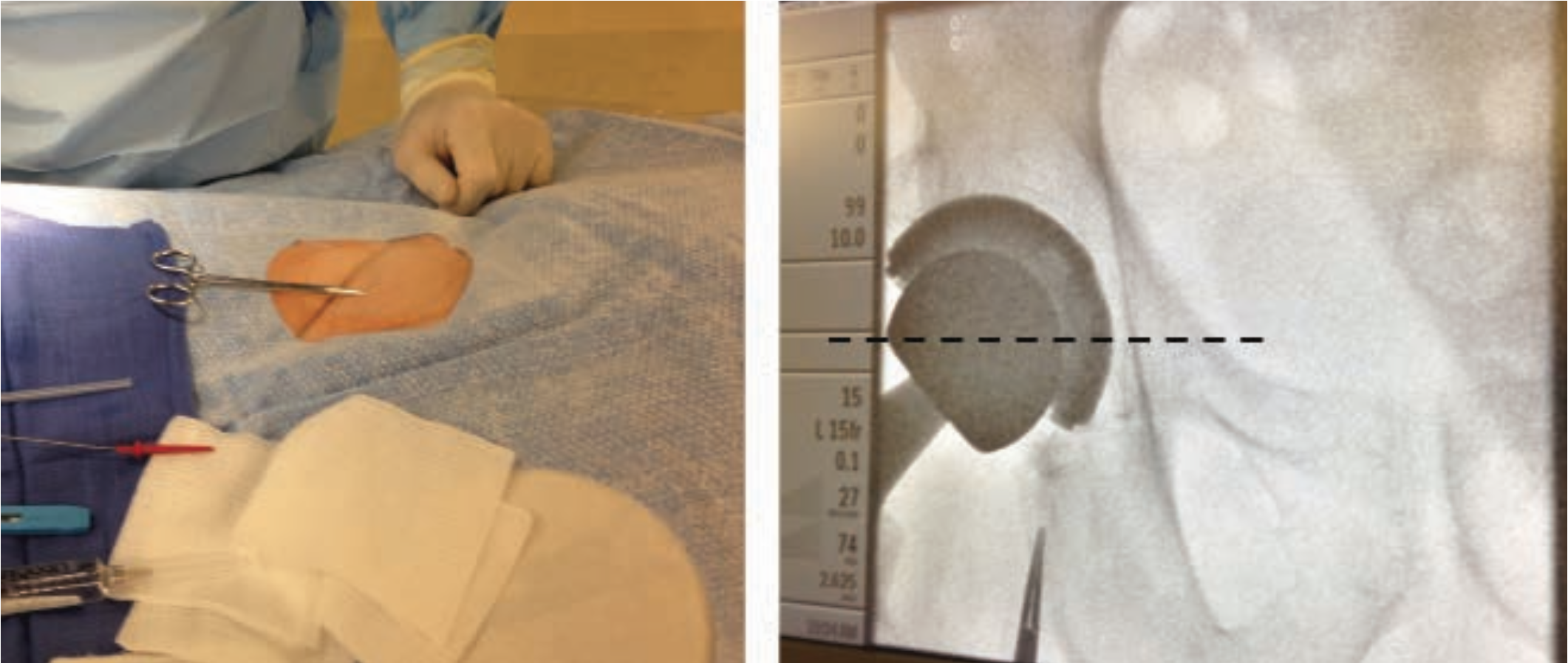 Back To Basics Femoral Artery Access And Hemostasis